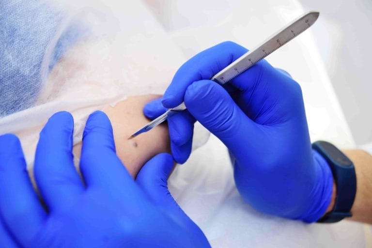 Mole Removal Before And After: Your Complete Guide